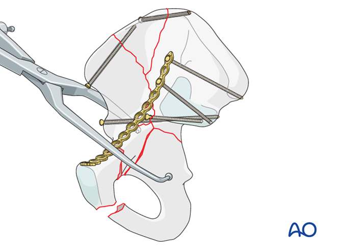 ORIF through ilioinguinal approach for Both columns