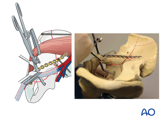 ORIF through ilioinguinal approach for Both columns