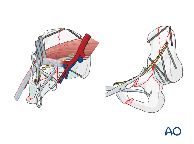 ORIF through ilioinguinal approach for Both columns
