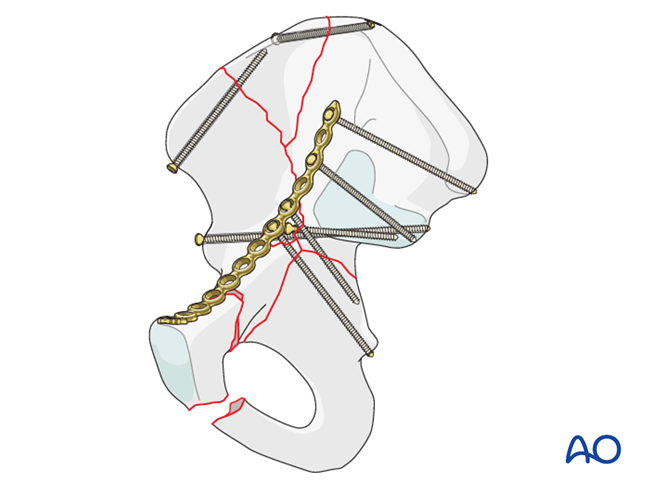 ORIF through ilioinguinal approach for Both columns