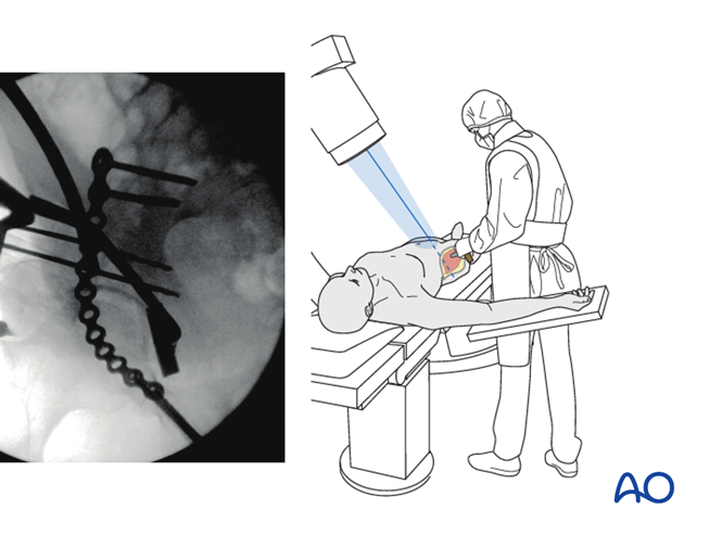 ORIF through ilioinguinal approach for Both columns