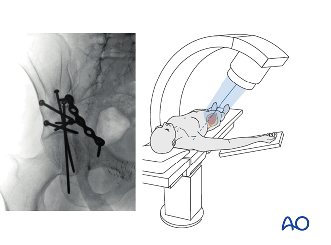 ORIF through ilioinguinal approach for Both columns