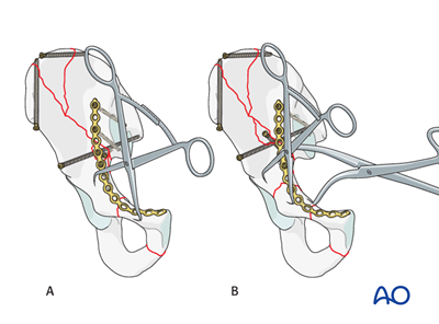ORIF through ilioinguinal approach for Both columns
