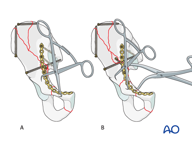 ORIF through ilioinguinal approach for Both columns
