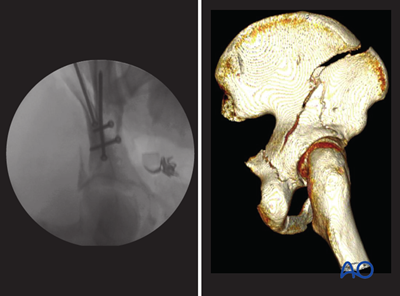 ORIF through modified Stoppa approach for Both columns