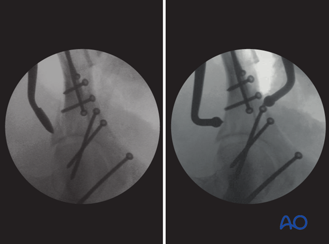 ORIF through modified Stoppa approach for Both columns