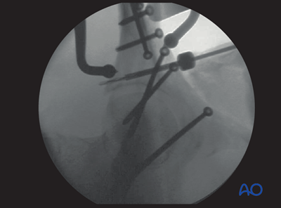 ORIF through modified Stoppa approach for Both columns