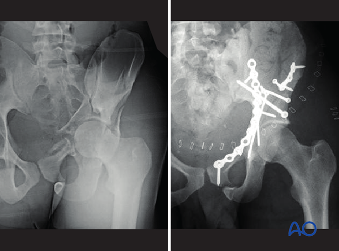ORIF through modified Stoppa approach for Both columns