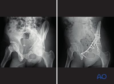 ORIF through modified Stoppa approach for Both columns