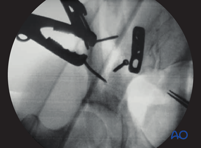 ORIF through modified Stoppa approach for Both columns