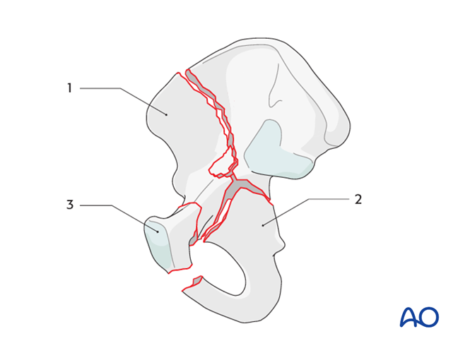 ORIF through modified Stoppa approach for Both columns