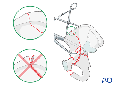 ORIF through modified Stoppa approach for Both columns