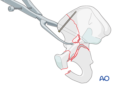 ORIF through modified Stoppa approach for Both columns