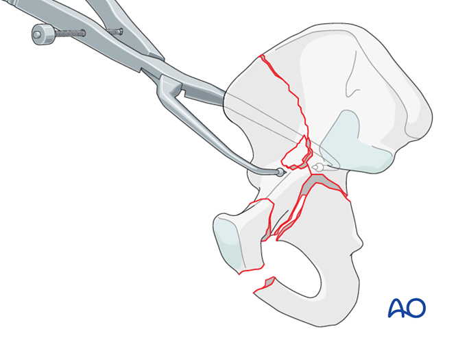 ORIF through modified Stoppa approach for Both columns