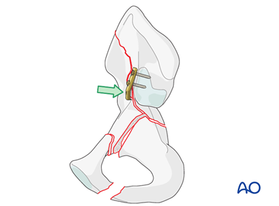 ORIF through modified Stoppa approach for Both columns