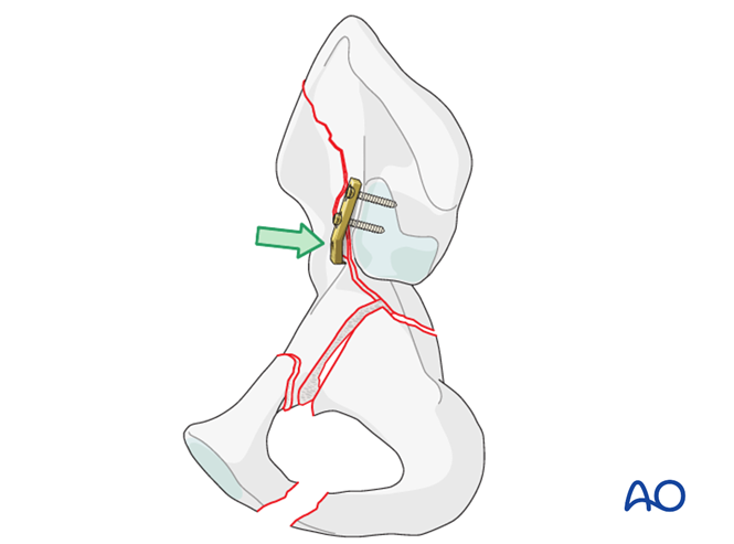 ORIF through modified Stoppa approach for Both columns