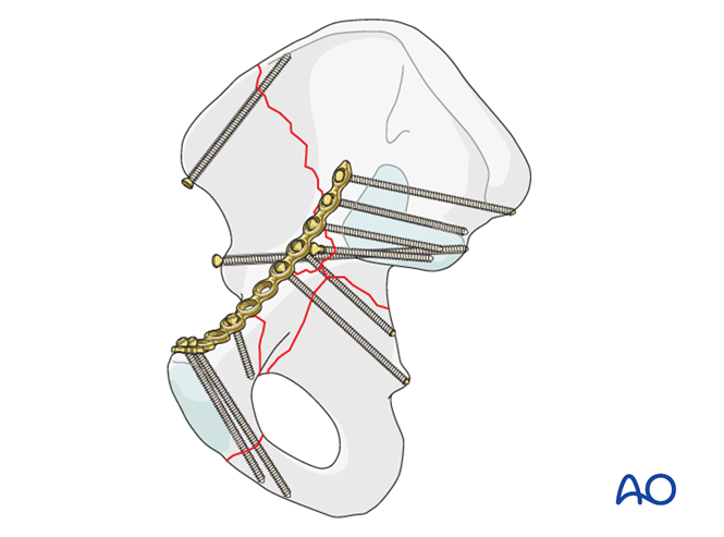 ORIF through modified Stoppa approach for Both columns
