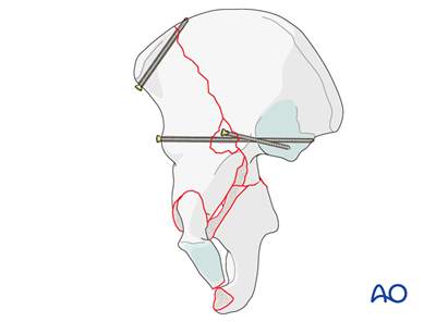 ORIF through modified Stoppa approach for Both columns