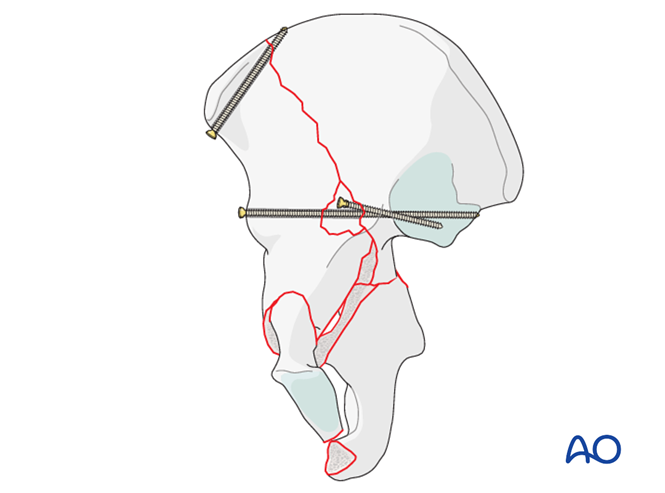 ORIF through modified Stoppa approach for Both columns