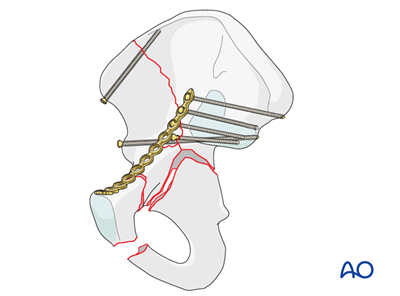 ORIF through modified Stoppa approach for Both columns