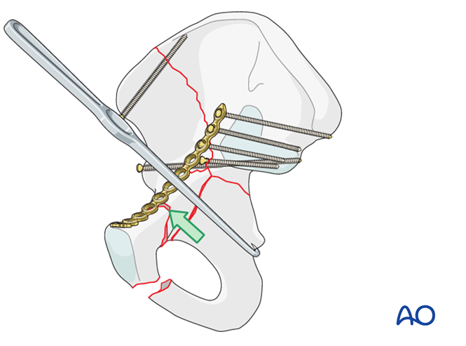 ORIF through modified Stoppa approach for Both columns