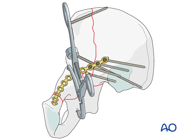 ORIF through modified Stoppa approach for Both columns