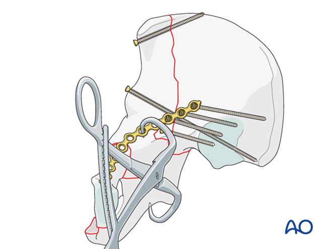 ORIF through modified Stoppa approach for Both columns