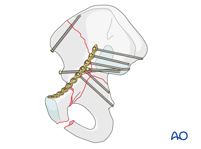ORIF through modified Stoppa approach for Both columns