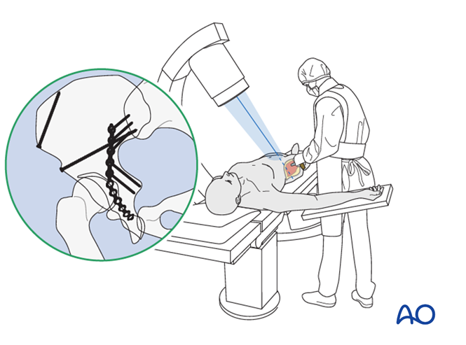ORIF through modified Stoppa approach for Both columns