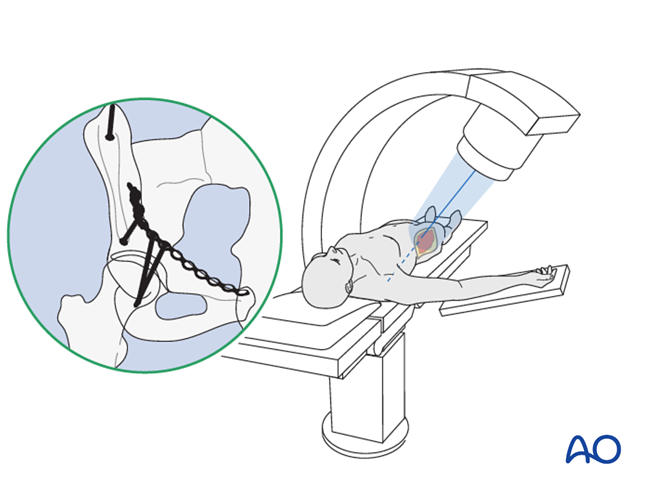 ORIF through modified Stoppa approach for Both columns
