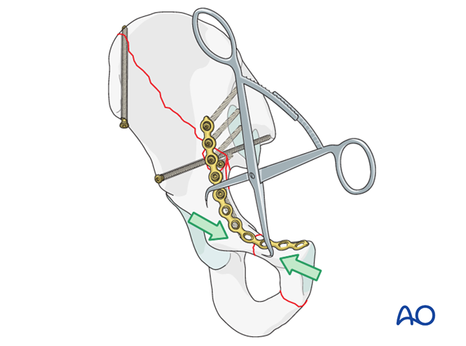 ORIF through modified Stoppa approach for Both columns