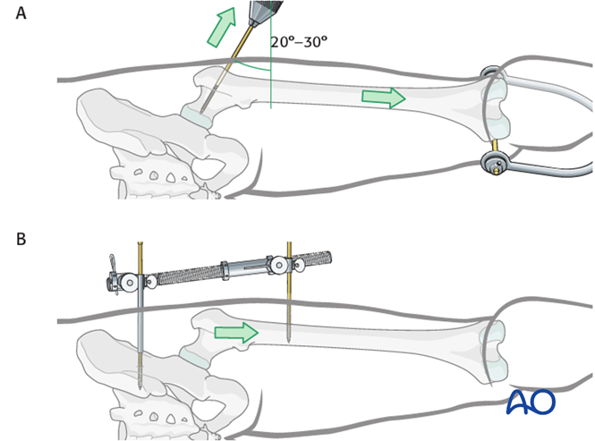 ORIF through extended iliofemoral approach for T-type