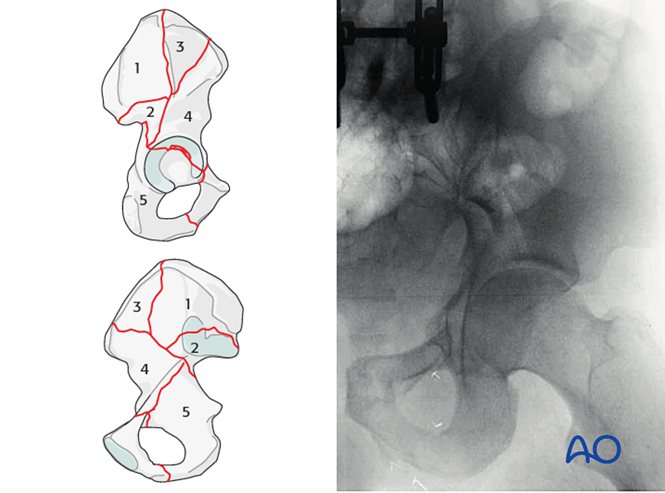 ORIF through extended iliofemoral approach for Both columns