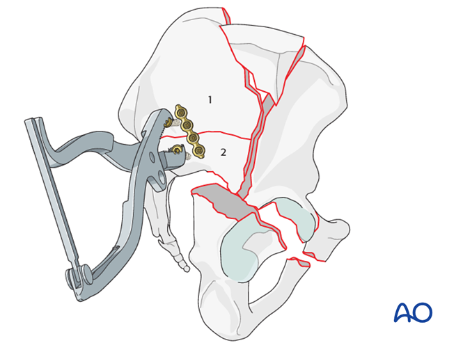 ORIF through extended iliofemoral approach for Both columns