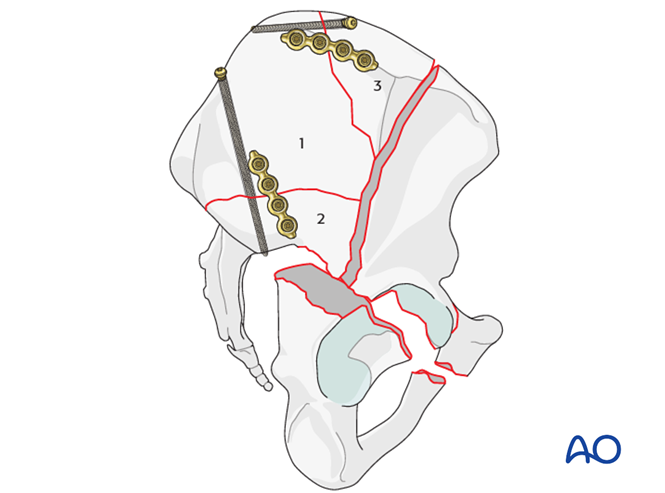ORIF through extended iliofemoral approach for Both columns