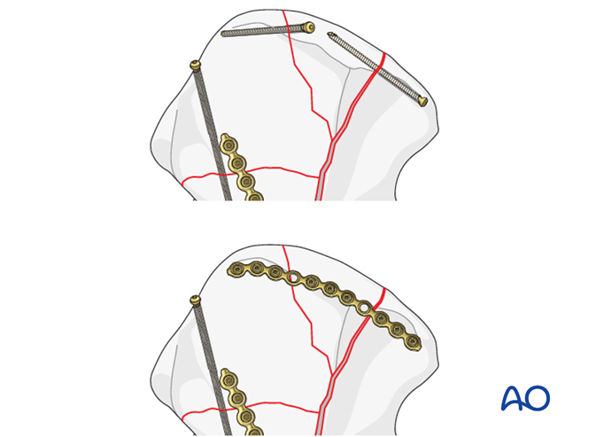 ORIF through extended iliofemoral approach for Both columns