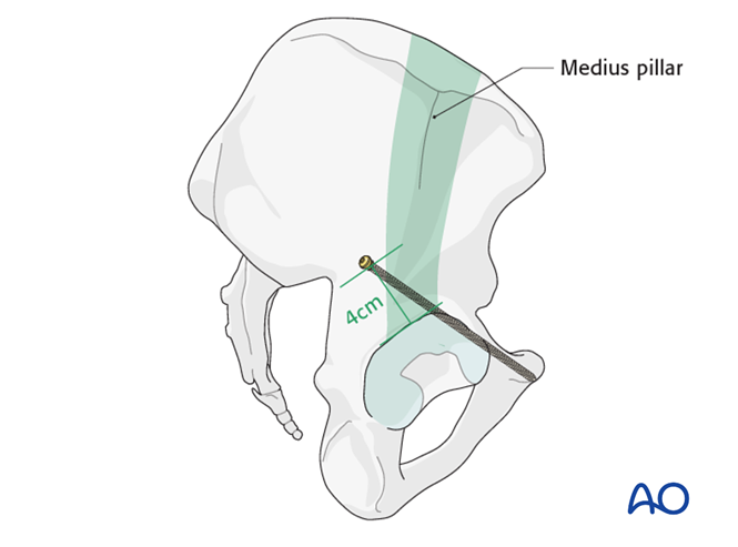 ORIF through extended iliofemoral approach for Both columns