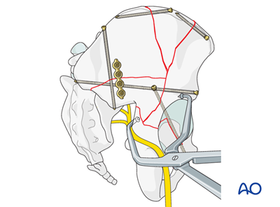 ORIF through extended iliofemoral approach for Both columns
