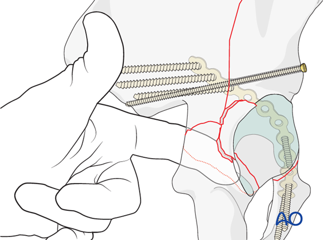 ORIF through sequential approaches for Both columns