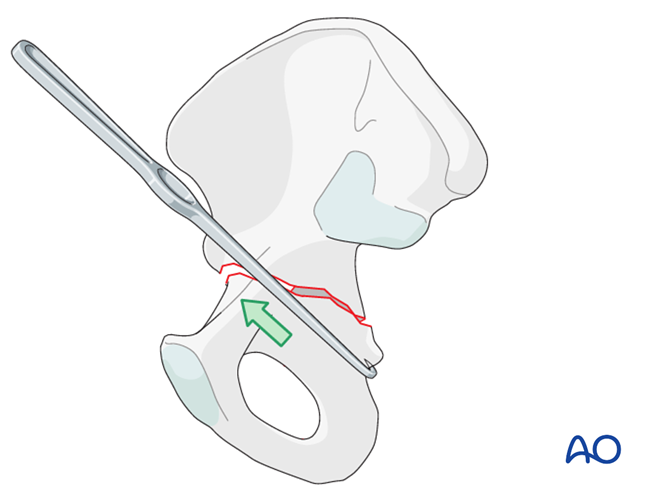 ORIF through modified Stoppa approach for Transverse