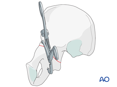 ORIF through modified Stoppa approach for Transverse