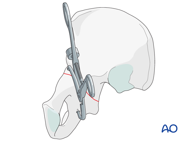 ORIF through modified Stoppa approach for Transverse