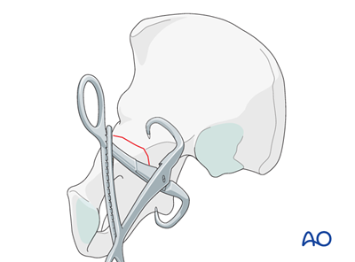 ORIF through modified Stoppa approach for Transverse