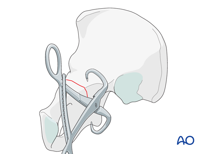 ORIF through modified Stoppa approach for Transverse