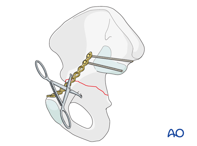 ORIF through modified Stoppa approach for Transverse