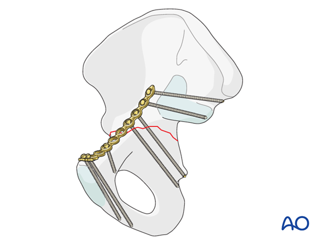 ORIF through modified Stoppa approach for Transverse