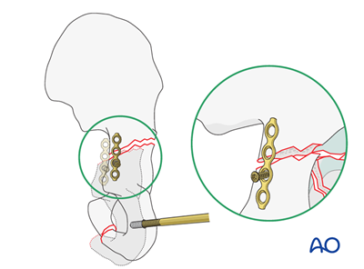 ORIF through extended iliofemoral approach for T-type