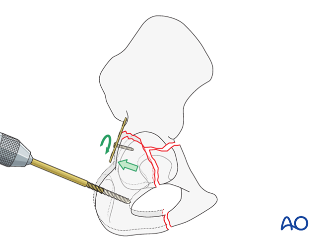 ORIF through extended iliofemoral approach for T-type