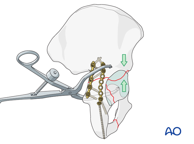 ORIF through extended iliofemoral approach for T-type