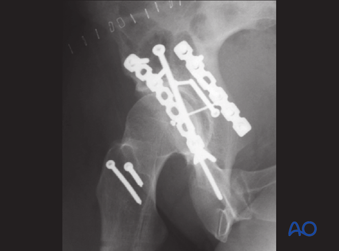 ORIF through extended iliofemoral approach for T-type